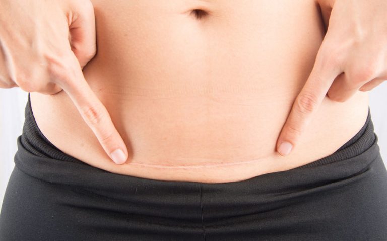 Littekens - Dila Skin Clinic Vianen – Huidverbetering, Laser & Beauty ...